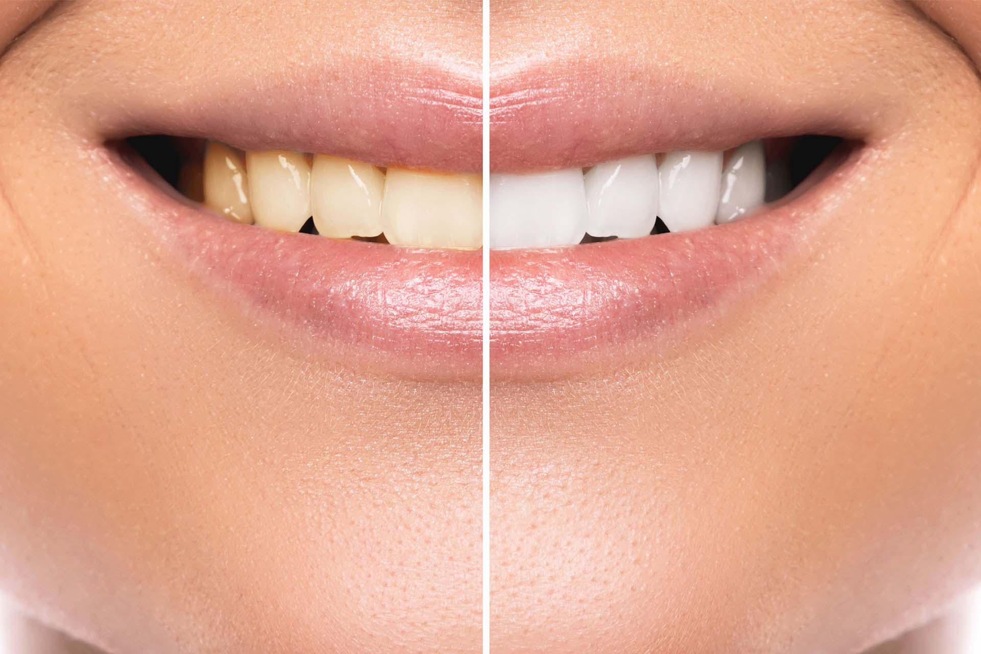 Zoom Teeth Whitening Treatments in Lakeshore: What to Expect ...
